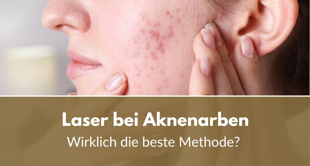 Laser bei Aknenarben: Die beste Methode zur Entfernung?